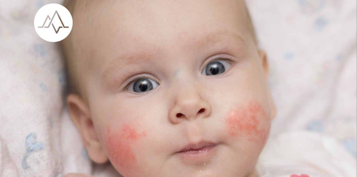 Dermatitis atópica: conoce sus síntomas y qué puede provocarla - Andes ...