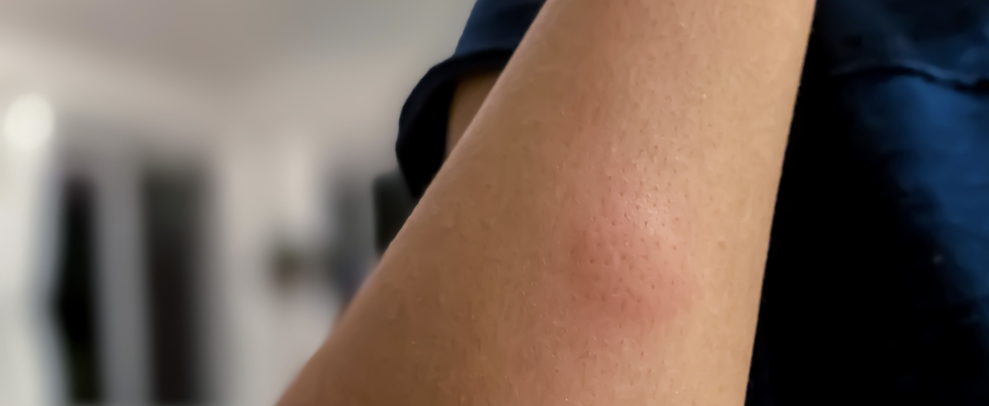 Picaduras de insecto y cuándo ir al Servicio de Urgencia - Andes Salud